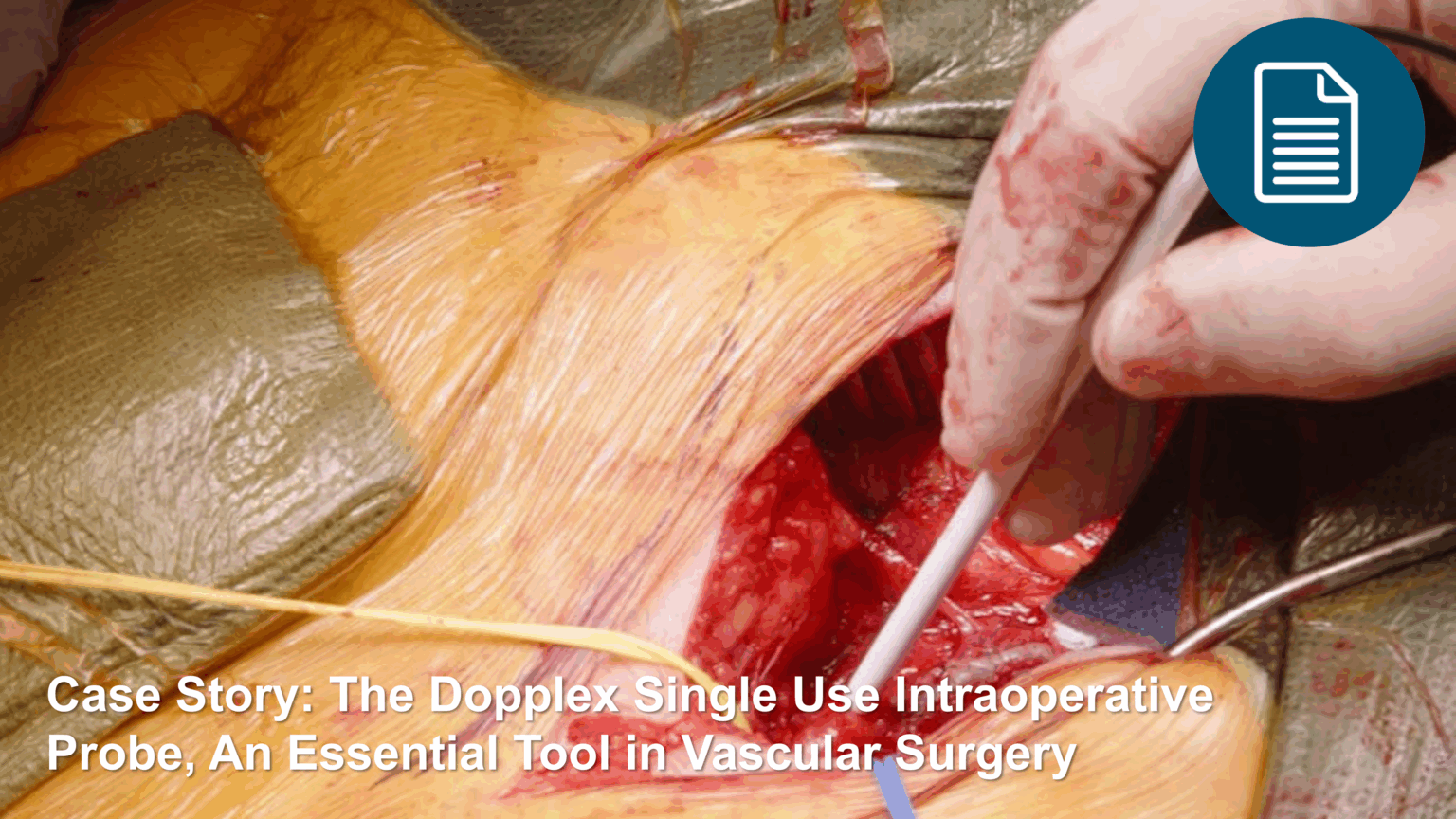 Dopplex® Single Use Intraoperative Doppler Probe - Huntleigh Healthcare